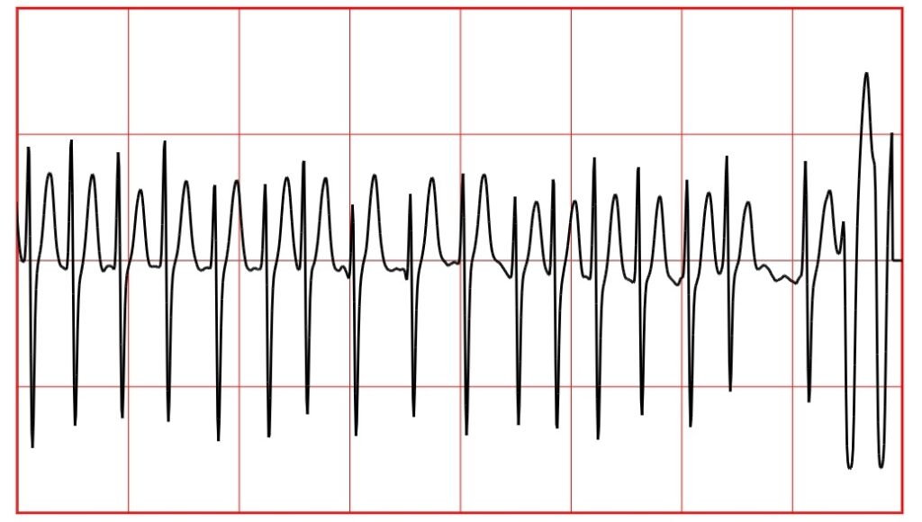 Measures and stats - Biosignals Solutions