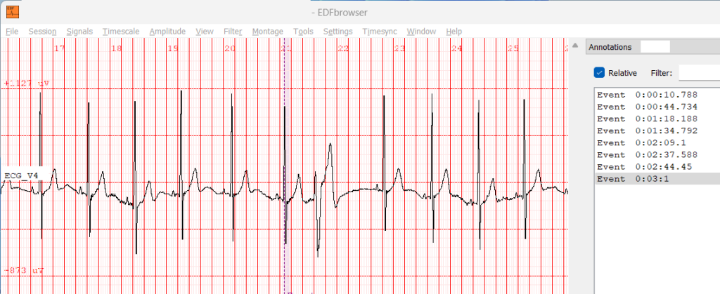 Polar ECG Analysis Help - Biosignals Solutions